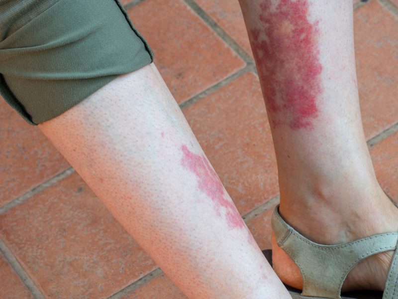How to Treat and Prevent Disney Rash (Pictures, Tips, and More ...